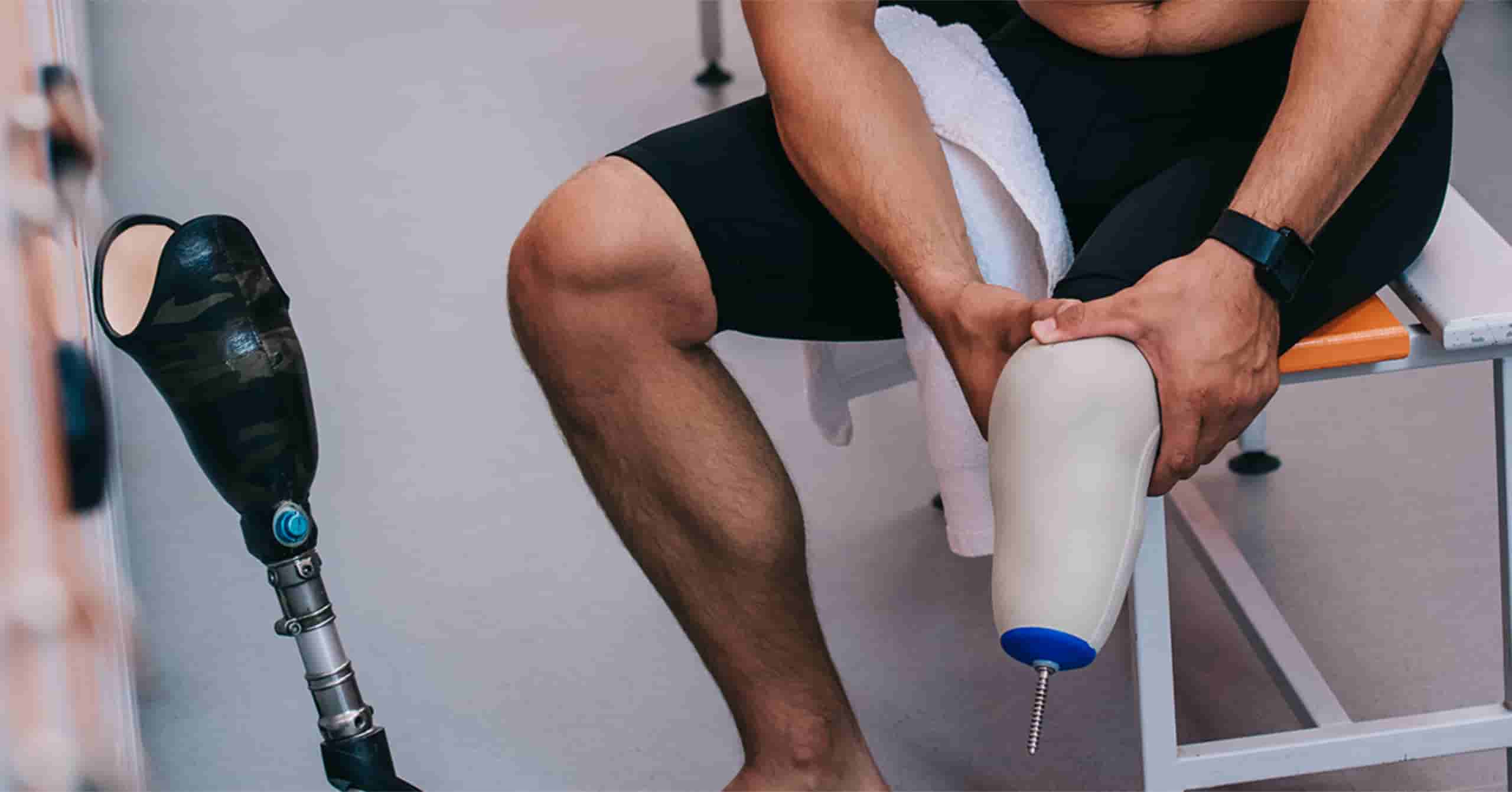 Phantom Limb Pain and MMJ - Rethink-Rx